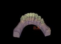 China Corrosion Resistant Dental Precision Attachments Custom To Patient’S Dental Anatomy for sale