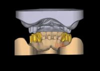 China Corrosion Resistant Dental Precision Attachments Custom To Patient’S Dental Anatomy for sale