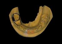 China Custom Dental Space Maintainers For Children 5-12 Years To Preserve Permanent Teeth Alignment for sale