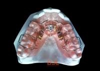 China Stainless Steel Acrylic Orthodontic Expander With Screw Activation For Children Adolescents for sale