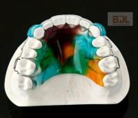 China Non Toxic Custom Removable Orthodontic Appliance Acrylic Resin And Metal Components for sale