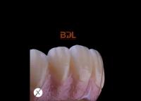 China Full Zirconia Ceramic Dentures High Precision Digital Production For Functional Restoration for sale