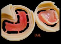 China Removable Full Acrylic Dentures Restores Chewing And Speaking Abilities for sale