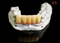 China High Fracture Toughness Ceramic Dentures with High Translucency and Low Thermal Conductivity for Dental Restorations for sale