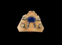 China Stainless Steel Acrylic Orthodontic Expander With Screw Activation For Children Adolescents for sale