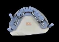 China 3D Printed Removable Partial Denture With Highly Polished Surface For Exquisite Appearance for sale