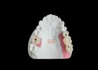 China Missing One Or More Teeth Implant CNC Precision Machining Occlusal Loading Time 6 Weeks for sale