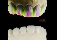 China Porcelain Emax Veneers With Cast Porcelain Ultra Thin Handmade Porcelain Stacking for sale
