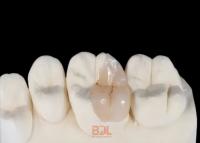 China High Translucency All-ceramic Restoration with High Fracture Toughness and CAD/CAM Compatibility for Dental Crowns for sale
