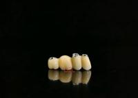 China Dental Implant Bar screw retained implant bridge multi unit fixed restoration for patients with multiple consecutive missing teeth for sale