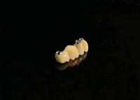 China Dental Implant Bar screw retained implant bridge multi unit fixed restoration for patients with multiple consecutive missing teeth for sale