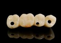 China Dental Implant Bar screw retained implant bridge multi unit fixed restoration for patients with multiple consecutive missing teeth for sale