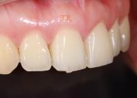 China Emax Veneer dental veneer with CAD CAM digital milling for customized anterior tooth restoration and improved smile aesthetics for sale