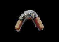 China Metal Partial Dentures made from medical grade cobalt chromium alloy framework ensuring long lasting performance and wearer comfort for sale