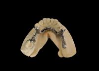 China Lightweight Cobalt-Chromium Alloy Metal Partial Dentures with Precision Cast Clasps for Mandibular RPD for sale