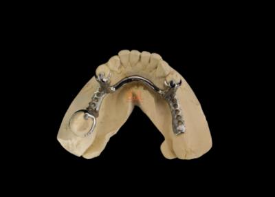 China Lightweight Cobalt-Chromium Alloy Metal Partial Dentures with Precision Cast Clasps for Mandibular RPD for sale