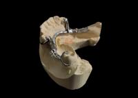 China Lightweight Cobalt-Chromium Alloy Metal Partial Dentures with Precision Cast Clasps for Mandibular RPD for sale