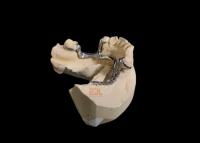 China Lightweight Cobalt-Chromium Alloy Metal Partial Dentures with Precision Cast Clasps for Mandibular RPD for sale