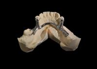 China Lightweight Cobalt-Chromium Alloy Metal Partial Dentures with Precision Cast Clasps for Mandibular RPD for sale