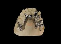 China High Strength Cobalt Chromium Metal Partial Dentures with Cast Clasps Lingual Bar Connector and Mesh Reinforcement for Mandibular Dental Restoration for sale