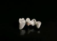 China Custom Made Porcelain Fused To Metal Partial Dentures with Titanium Metal Framework and Anatomically Contoured All Ceramic Bridge for sale