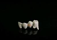 China Custom Made Porcelain Fused To Metal Partial Dentures with Titanium Metal Framework and Anatomically Contoured All Ceramic Bridge for sale