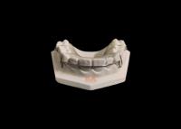 China Custom-fit Orthodontic Retainers with Hypoallergenic Materials and Removable Design for Comfortable Wear for sale