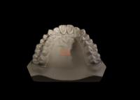 China Custom-made Orthodontic Retainers with Medical-grade Acrylic for Gentle Continuous Force and Superior Comfort for sale
