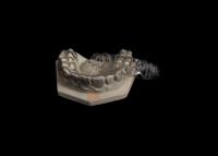 China Custom-made Orthodontic Retainers with Medical-grade Acrylic for Gentle Continuous Force and Superior Comfort for sale