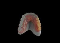 China No Metal Showing Hypoallergenic Flexible Partial Denture with 3-Day Turnaround for Comfortable Dental Restoration for sale
