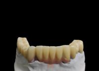 China Esthetic Ceramic Dentures with Anatomically Accurate Crowns and Polished Margins for Comprehensive Tooth Loss Treatment for sale