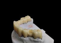 China Esthetic Ceramic Dentures with Anatomically Accurate Crowns and Polished Margins for Comprehensive Tooth Loss Treatment for sale