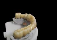 China Esthetic Ceramic Dentures with Anatomically Accurate Crowns and Polished Margins for Comprehensive Tooth Loss Treatment for sale