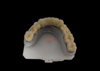 China Esthetic Ceramic Dentures with Anatomically Accurate Crowns and Polished Margins for Comprehensive Tooth Loss Treatment for sale