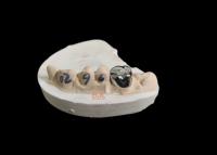 China Porcelain Fused To Metal crowns produced with lost wax casting or digital milling technology delivering excellent marginal fit and dental function for sale