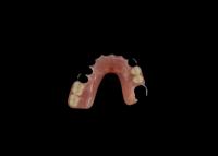 China Metal Framework Partial Dentures Featuring Ergonomic Design and Robust Construction Ideal for Dental Prosthetic Solutions for sale
