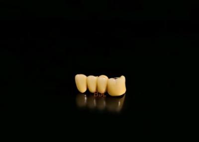 China Durable Porcelain Fused To Metal Crown Customized Shade Matching Long Lasting Dental Restoration Solution for sale