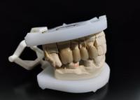 China Durable Porcelain Fused To Metal Crown Customized Shade Matching Long Lasting Dental Restoration Solution for sale