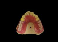 China Comfort Fit Durable Complete Acrylic Denture Precision Engineered Material Lightweight Suitable Dental Solutions for sale