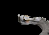 China Safe Pediatric Dental Space Maintainers Manufactured to Maintain Tooth Alignment and Prevent Early Tooth Loss Complications for sale