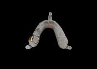 China Safe Pediatric Dental Space Maintainers Manufactured to Maintain Tooth Alignment and Prevent Early Tooth Loss Complications for sale
