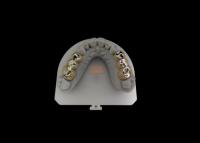 China High Strength Porcelain Fused To Metal Crown Suitable For Dental Applications Requiring Both Durability And Beauty for sale