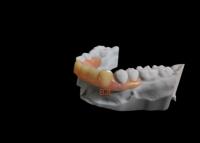 China Flexible Partial Denture Prosthesis made from flexible nylon material offering superior comfort natural look and durability for sale