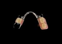 China Precision Metal Removable Partial Dentures Engineered for Accurate Fit and Performance in Dental Restoration Procedures for sale