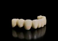China Durable Metal Bonded Porcelain Crown Offering Long Lasting Strength and Natural Appearance Ideal for Dental Restorations for sale