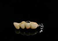 China Durable Porcelain Fused To Metal Crown Engineered For Optimal Fit And Longevity Supporting Dental Clinics And Laboratories for sale