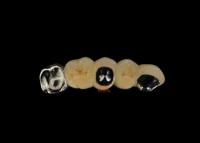 China Durable Porcelain Fused To Metal Crown Engineered For Optimal Fit And Longevity Supporting Dental Clinics And Laboratories for sale