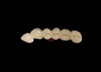 China Precision Fit Porcelain Fused To Metal Crown Providing Enhanced Strength And Natural Tooth Color For Dental Applications for sale