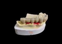 China Precision Fit Porcelain Fused To Metal Crown Providing Enhanced Strength And Natural Tooth Color For Dental Applications for sale