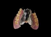 China Biocompatible Metal Framework Partial Dentures manufactured to meet stringent dental industry standards and patient safety for sale